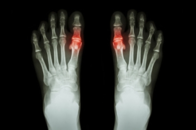 Ankle N Foot - Podiatrist, Foot Doctor Chicago, Elmhurst, and Bartlett, IL